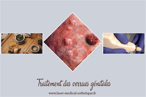 Comment Traiter Condylome Crête De Coq