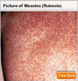 Measles Pictures Treatment Causes Symptoms And Mmr Vaccine
