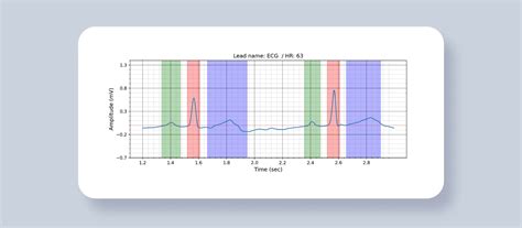 HRV Analysis Atrial Fibrillation Detection Using ML