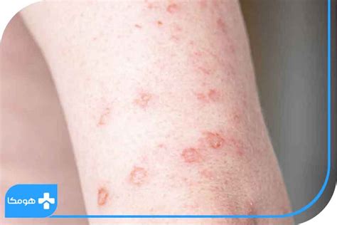 علائم ایدز در مردان و زنان چیست؟ مجله هومکا