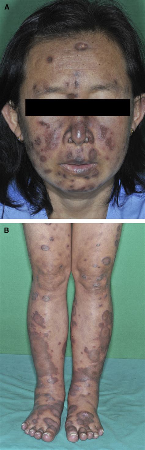Clinical Features Of Disseminated Cutaneous Leishmaniasis A Diffuse Download Scientific
