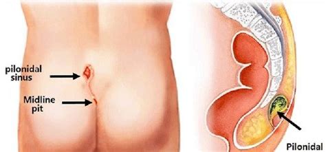 Pilonidal Sinus Treatment Without Surgery In Dubai