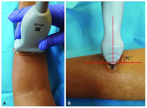 The Probe Position During The Ultrasound Us Imaging Assessment Of The