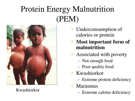 Ppt Malnutrition Powerpoint Presentation Id791012