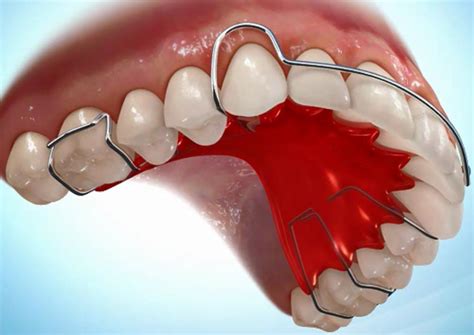 Choosing Between A Removable Retainer And A Permanent Retainer Vermette Orthodontics
