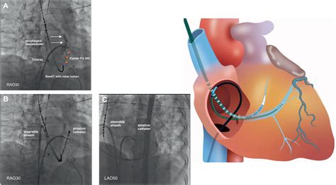 Multitechnique Approach For Peri Mitral Flutter A Case Report Of