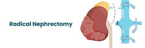 Radical Nephrectomy Benefits Risks Procedure And Recovery