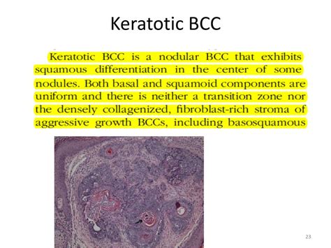 Ppt External Ear Basosquamous Cell Carcinoma Powerpoint Presentation Id 4127661