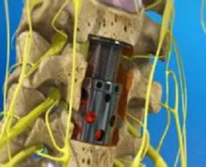 Anterior Cervical Corpectomy Spine Surgery Anavara