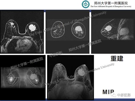 【病例】乳腺交界性叶状肿瘤1例影像 影像ppt