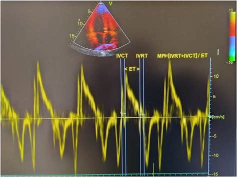 Tissue Doppler Derived Mpi Download Scientific Diagram