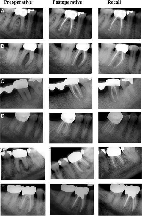 Endodontic Treatment Through Existing Full Coverage Restorations