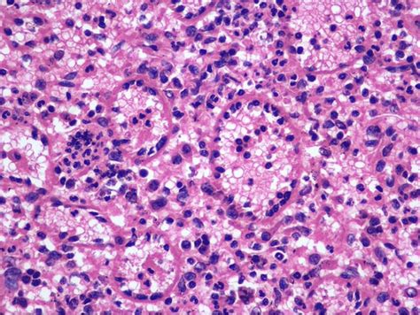 Microscopy Of Splenectomy Specimen Hematoxylin And Eosin 400×