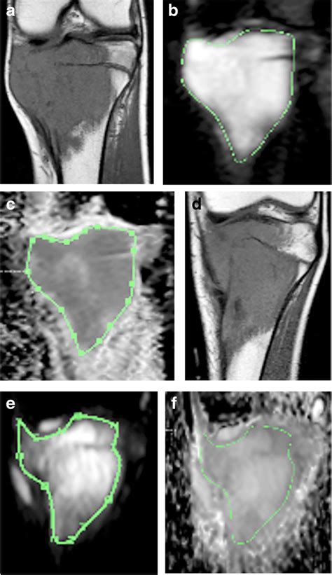 Osteosarcoma Of The Proximal Tibial Metaphysis With Extension To Download Scientific Diagram Osteosarcoma Of The Proximal Tibial Metaphysis With Extension To Download Scientific Diagram