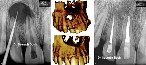 Non Surgical Management Of Large Apical Lesion With Open Apex Style Italiano Endodontics