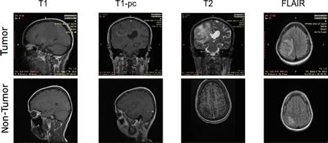 In This Figure A Portion Of The Binary Dataset Is Shown With Four Mri