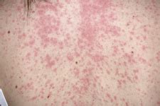 Amoxicillin Rash Allergic Reaction