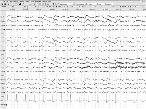 Electroencephalographic Assessment Of Coma Journal Of Clinical Neurophysiology