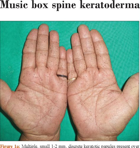 Figure 1 From Music Box Spine Keratoderma Semantic Scholar