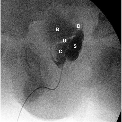 Vcug Lateral View Showing Dilated Left Seminal Vesicle S Seminal