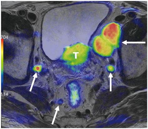 Re Diffusion Weighted Imaging Of Prostate Cancer How Can We Use It