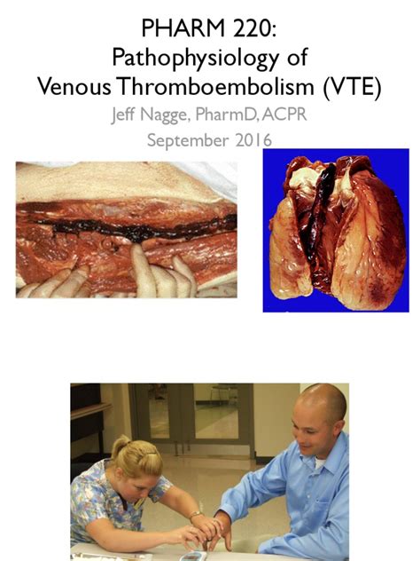 Venous Thromboembolism Vte Pathophysiology September 2016 Pdf
