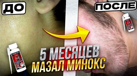 Начал мазать Минокс на бороду что со мной стало? / Андрей Борода ...