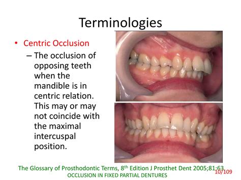 Occlusion In Fixed Partial Denture Pptx Dental Health Diseases And Conditions