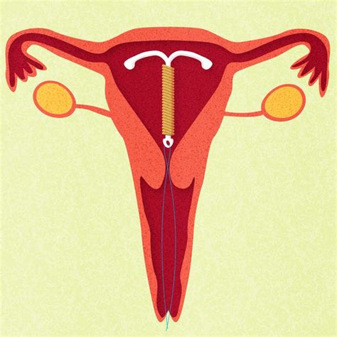 Sex With An Iud What You Need To Know