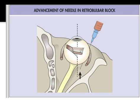 Ocular Anesthesia
