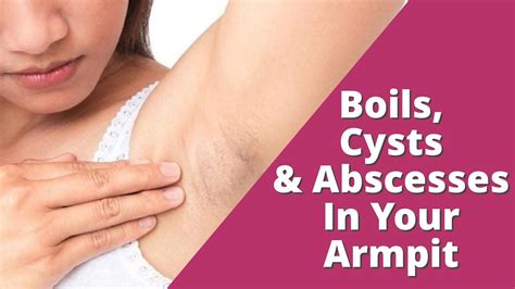 How To Treat Boils Cysts And Abscesses In Your Armpit Lumps In The
