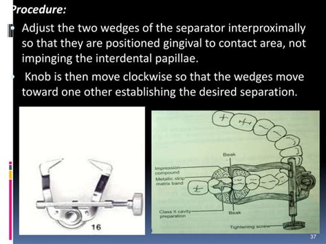 matrices retainers wedges and separators ppt dental health