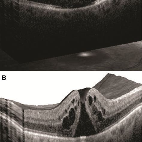 Pdf Macular Hole Formation In A Patient With Irvine Gass Syndrome