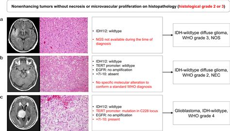 The 2021 Who Classification For Gliomas And Implications On Imaging