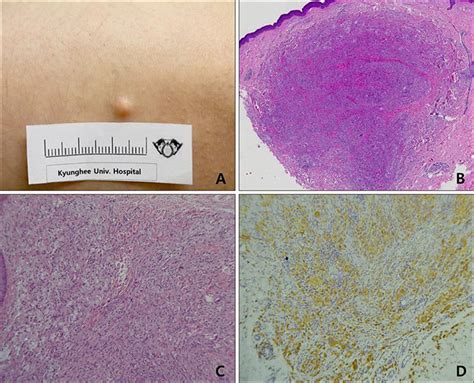 Lipidized Fibrous Histiocytoma Differential Diagnosis From Juvenile