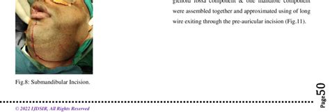 Assembled Mandibular Prosthesis With Glenoid Fossa Component Surgical Download Scientific