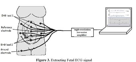 Figure 3 From A Novel Approach Of Fetal Ecg Extraction Using Adaptive