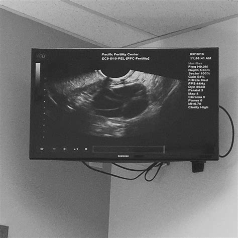 Egg Retrieval Egg Collection Your Bump My Heart