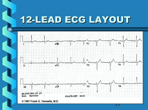 Ecg Made Easy Ppt