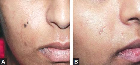 Junctional Nevus Removal