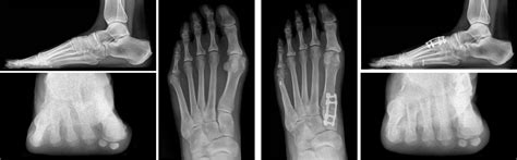 Clinical Results Treace Medical Concepts Inc