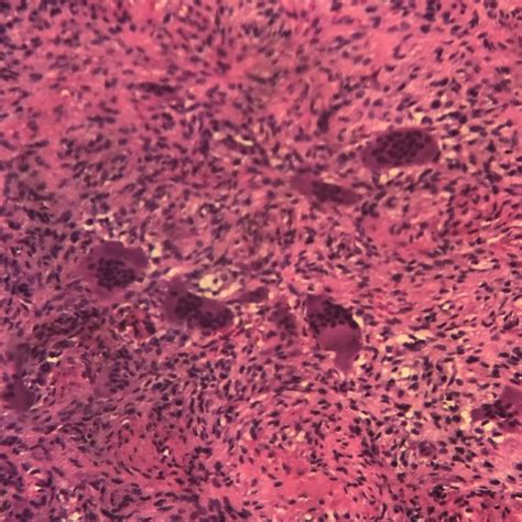 Medium Power View Shows Osteoclast Like Multinucleated Giant Cells
