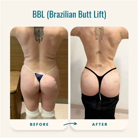 Brazilian Butt Lift Sculpting With Natural Fat Imed Medical
