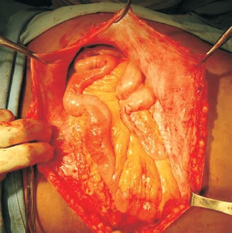 Operative Photograph Showing Inter Muscular Parietal Wall Hernia