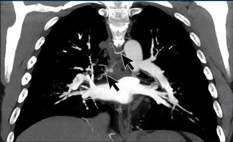 The Radiology Assistant Pulmonary Hypertension And Thromboembolic Disease