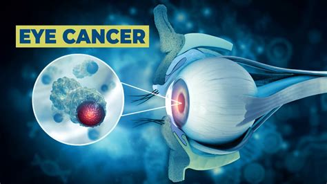 Eye Cancer
