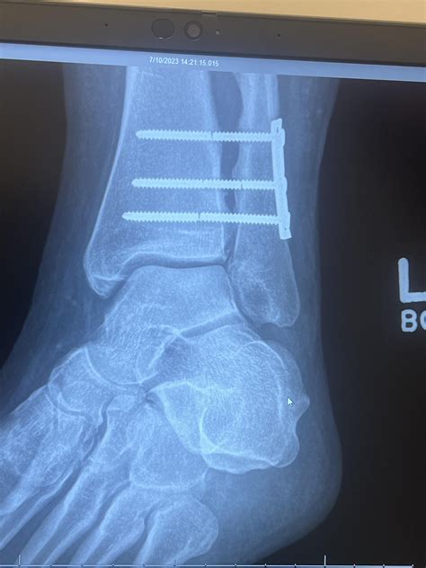 Hardware Replacement R Orif