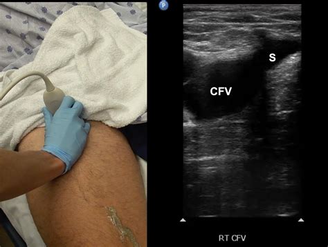 Pocus Spotlight Lower Extremity Dvt Scanning