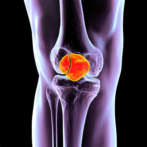 Bipartite Patella A Condition Where The Kneecap Has An Unfused