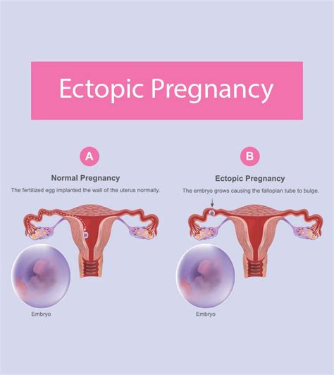 Ectopic Pregnancy Causes Symptoms Treatment And Risks